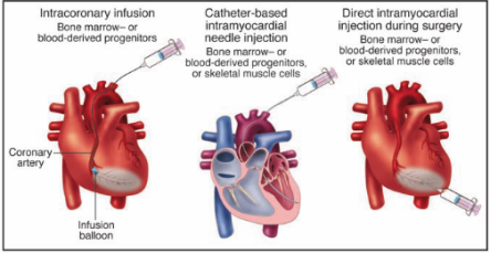 Is stem cell therapy a viable option for treatment of cardiac disease ...