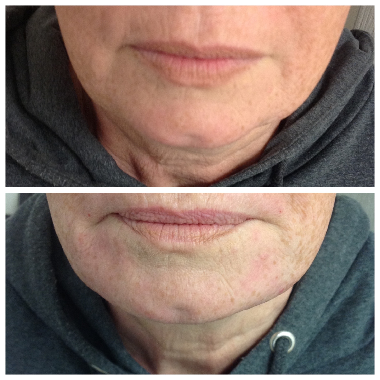 Jaw Line Chin Jowl | Botox Fillers Sheffield £70