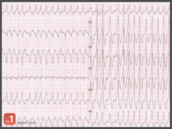 Wolff Parkinson White Syndrome