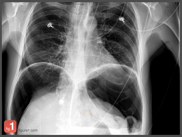 Pneumoperitoneum | Nursing Times
