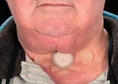 Tracheostomy 4: supporting patients following a laryngectomy | Nursing ...