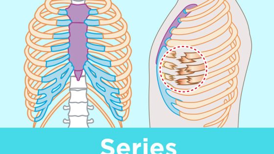 Trauma nursing 2: management of patients with rib fractures | Nursing Times