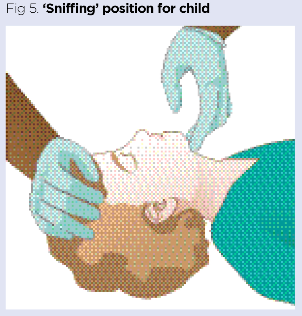 Paediatric emergency trolley 1: equipment to support airway and ...
