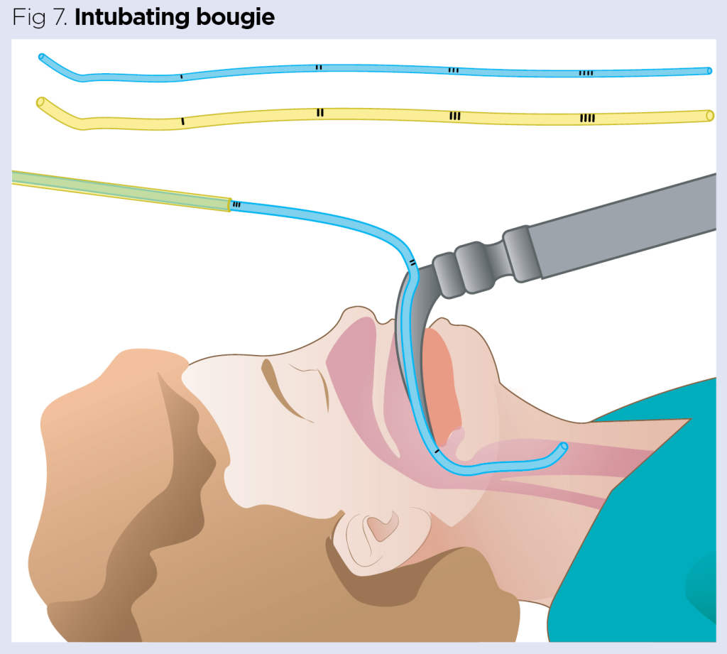 Paediatric emergency trolley 1: equipment to support airway and ...