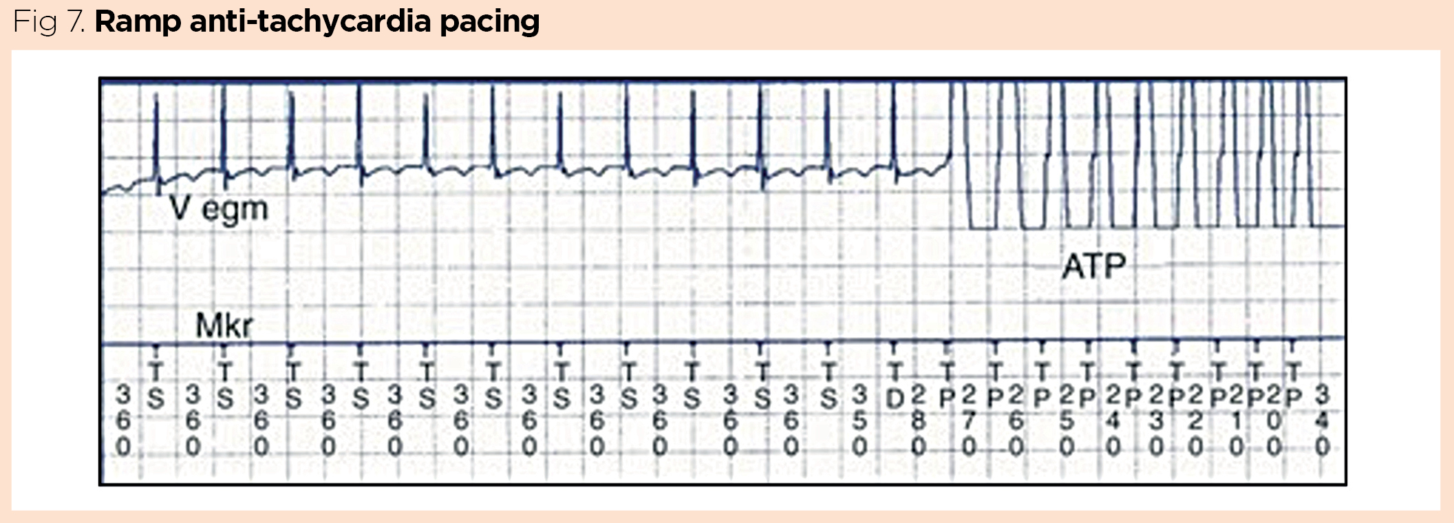 Complex cardiac device therapy 1: implantable cardioverter ...