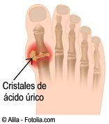 Enciclopedia Salud: Definición de Gota