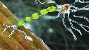 Amyotrophic lateral sclerosis, the drug tofersen approved in the United ...