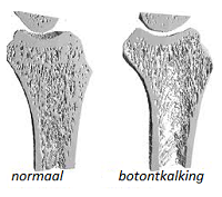 Botontkalking: de beste 8 tips om dit te voorkomen