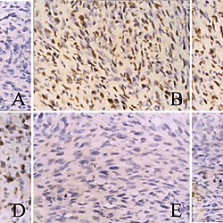 Immunohistochemistry of tissue microarray (magnification 400×)
