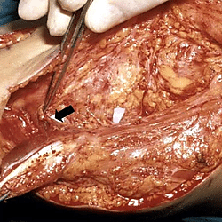 Conjoined tendon preperation