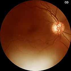 Retinography from patient #18