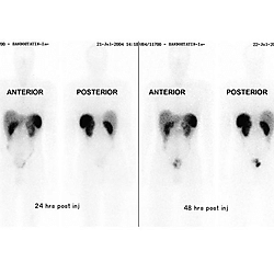 The normal octreotide scan of the patient looking for evidence of ...