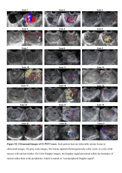 Figure S2. Ultrasound images of 21 PSTT cases.