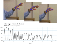 DeepLabCut finger tapping bradykinesia