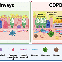 Airway epithelial remodeling in COPD_Aravind Reddy Tarugu.jpg