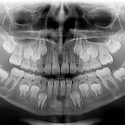 Dental Panoramic Scan (Part2)
