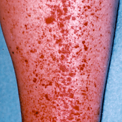 Numerous lesions of palpable purpura on the legs