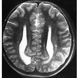 The Syndrome of Frontonasal Dysplasia, Callosal Agenesis, Basal ...