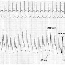 Pulse oximetry plethysmographic waveform analysis