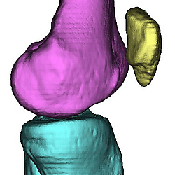 Initial 3D computer model of the knee joint produced using Mimics by ...