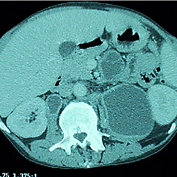 Abdominal CT demonstrating multiple abscessed intra-abdominal lymph nodes