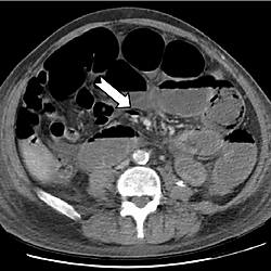 CT scan showing multiple dilated loops of small bowel with free fluid ...