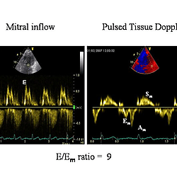 Standard Doppler derived transmitral inflow pattern (left panel) and ...