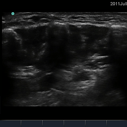 Spectral tissue sensing to identify intra- and extravascular needle ...