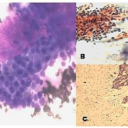 Fine needle aspiration biopsy of intraoral and oropharyngeal mass lesions-2