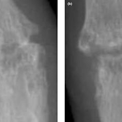 Recortication and filling in at a right fourth PIP joint