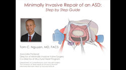 Minimally Invasive ASD Repair: Step-by-Step Guide