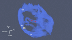 Video_1_Morphological Substrates for Atrial Arrhythmogenesis in a Heart ...