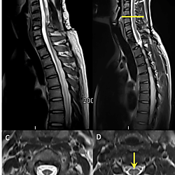 Image_1_Spinal Cord Imaging Markers and Recovery of Volitional Leg ...