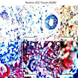 Image_3_Complement Factor H in cSCC: Evidence of a Link Between Sun ...