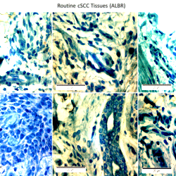 Image_5_Complement Factor H in cSCC: Evidence of a Link Between Sun ...