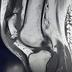 Image4_Treatment of proximal patellar tendon rupture with custom-made ...