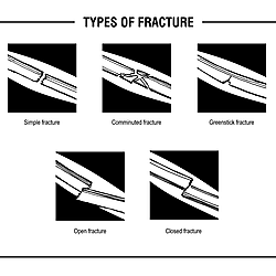 Types of fracture