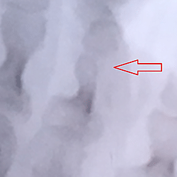 Additional file 9 of Efficacy and safety of condylectomy with minimally ...