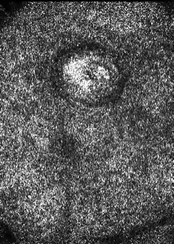 Media 2: MEMS-based handheld confocal microscope for in-vivo skin imaging