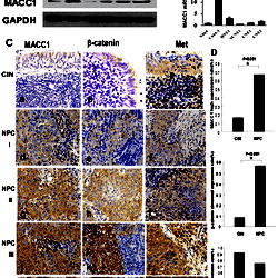 MACC1 protein expression in NPC cell lines (C666-1, HNE1, SUNE-1, CNE1 ...