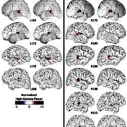 Left and Right STG High Gamma Response Patterns to PSS.