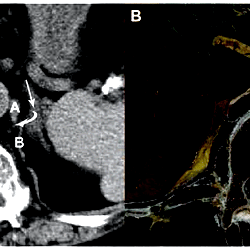 Visualization of the pathway into the retrocrural space by penetrating ...