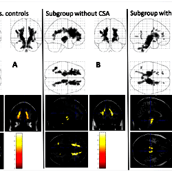 SPM "glass brain" representations (upper row) and statistical FA maps ...