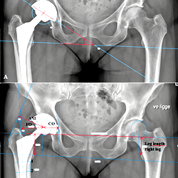 Example of measurements in TraumaCad®.