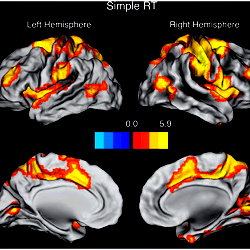 Brain activations revealed by the parametric contrast of RT in the ...