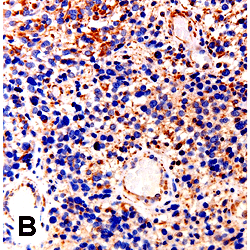 Immunohistochemical staining of ABC-transporters in pHGG sections.
