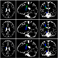 Comparison of two-ROI-approach, whole brain tractography and repeated ...