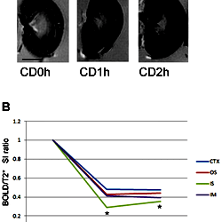 T2* weighted MRI successfully detect massive red cell congestion (RCC ...
