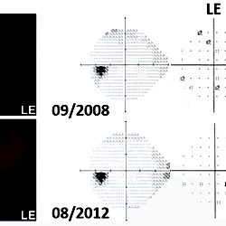 Optic disc appearance and visual fields of Patient 1.