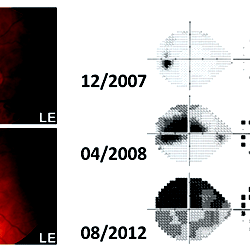 Optic disc appearance and visual fields of Patient 3.